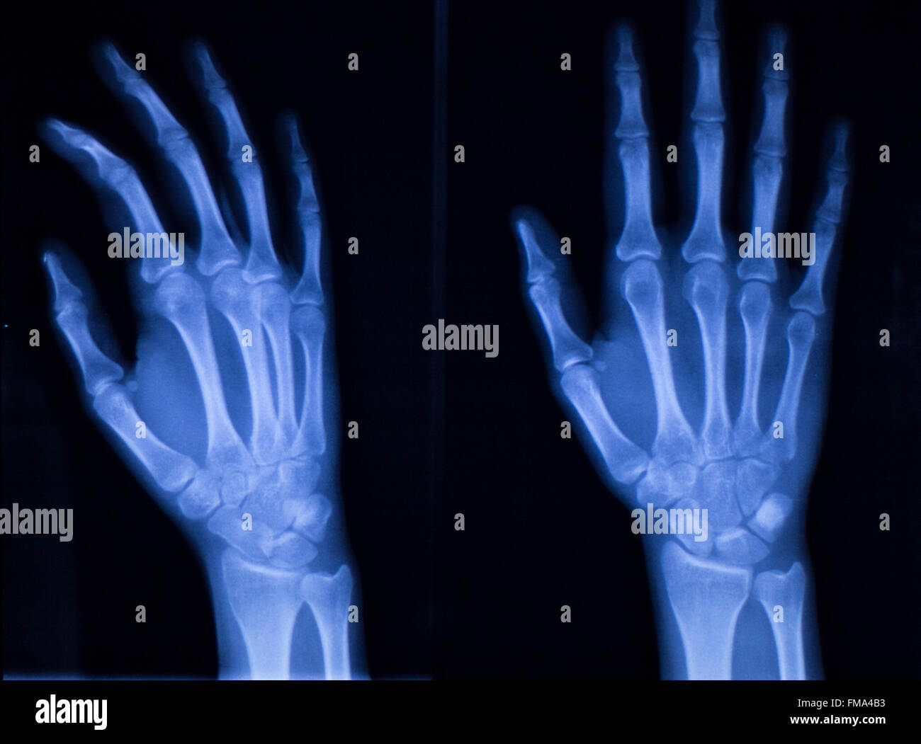 Wrist Sprain X Ray