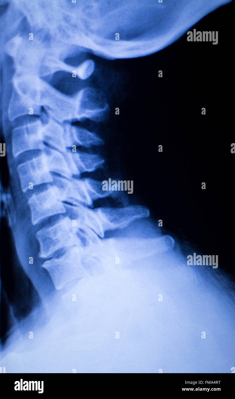 Skull, neck, spine, vertebra and shoulders injury medical x-ray test ...