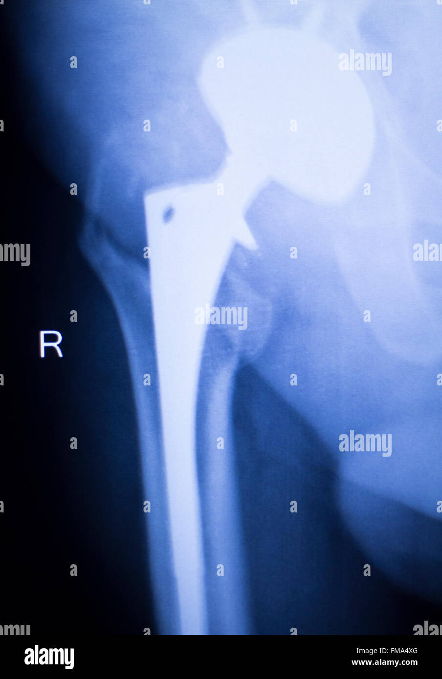 Hip replacement xray High Resolution Stock Photography and Images - Alamy