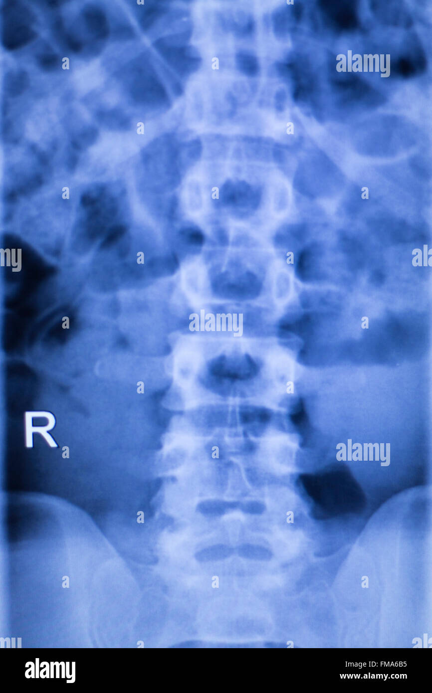 Spine vertebra back injury vertebral column medical x-ray test scan ...