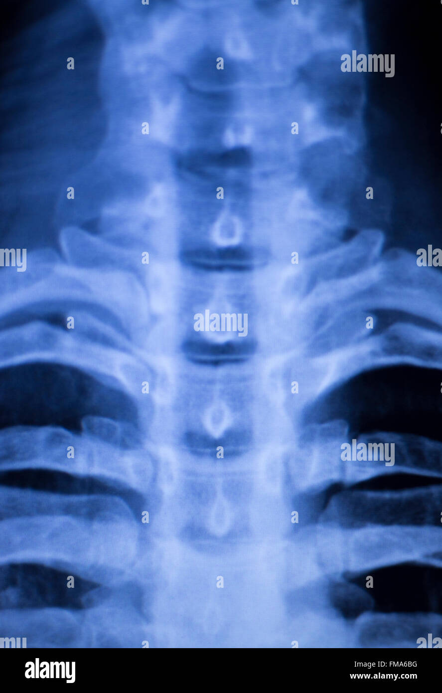Spine vertebra back injury vertebral column medical x-ray test scan ...