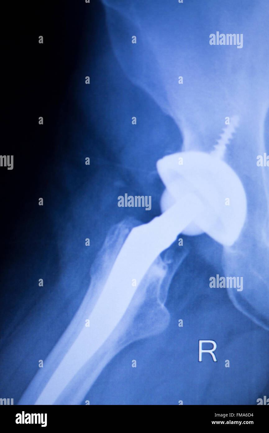 Hip joint meniscus orthopedic titanium metal replacement implant xray ...