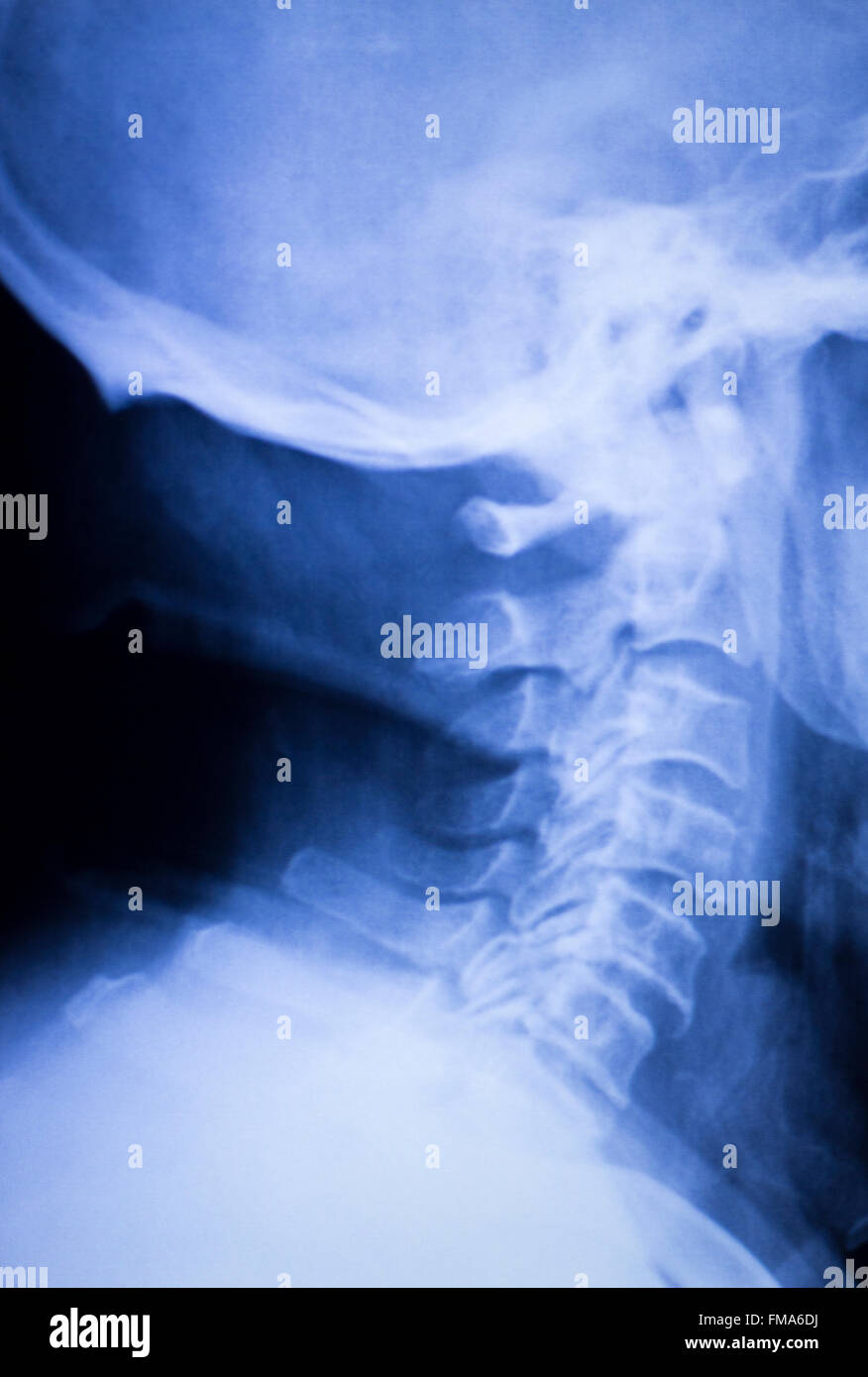 Skull, neck, spine, vertebra and shoulders injury medical x-ray test ...