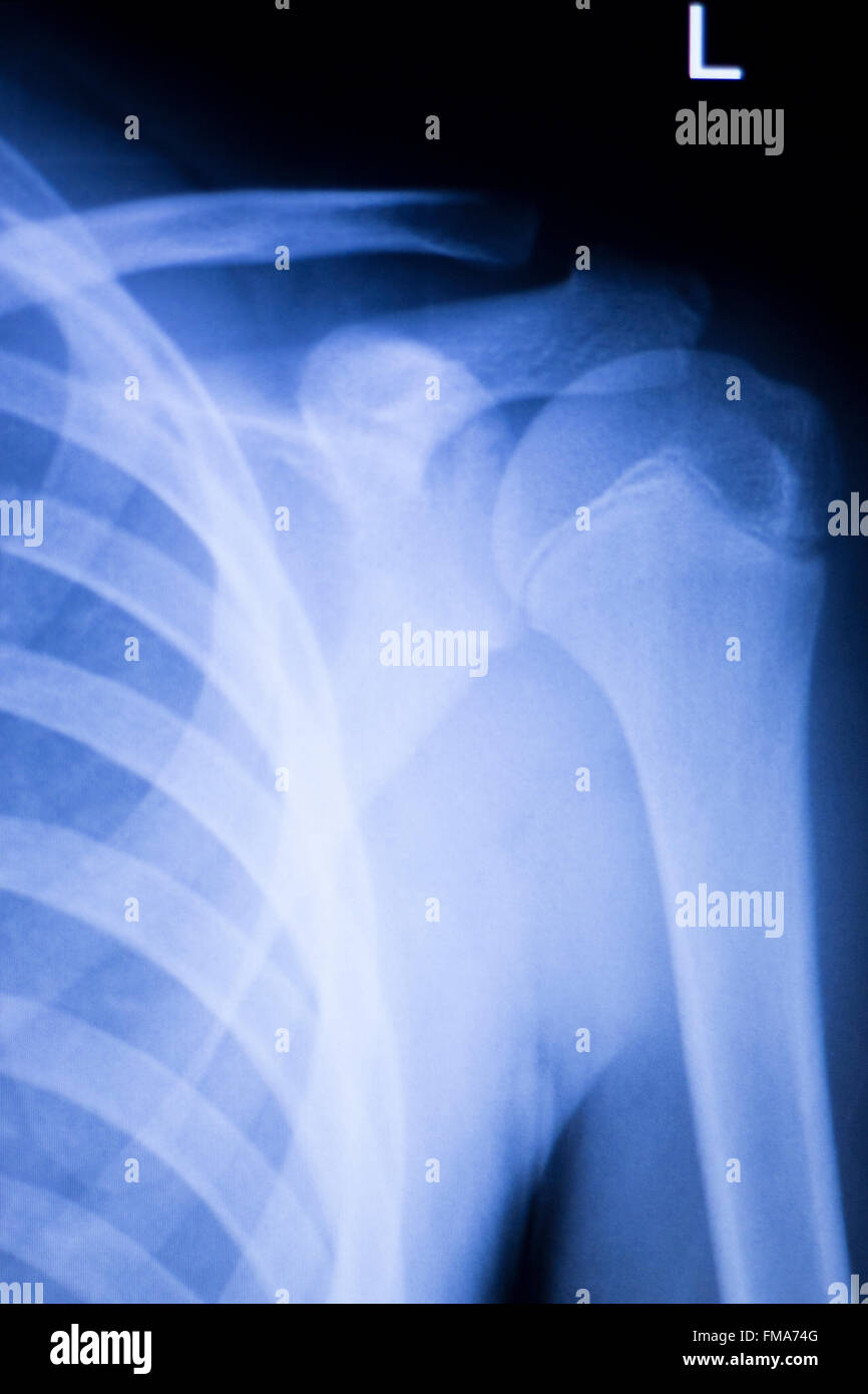 Spine vertebra ribs back injury vertebral column medical x-ray test ...