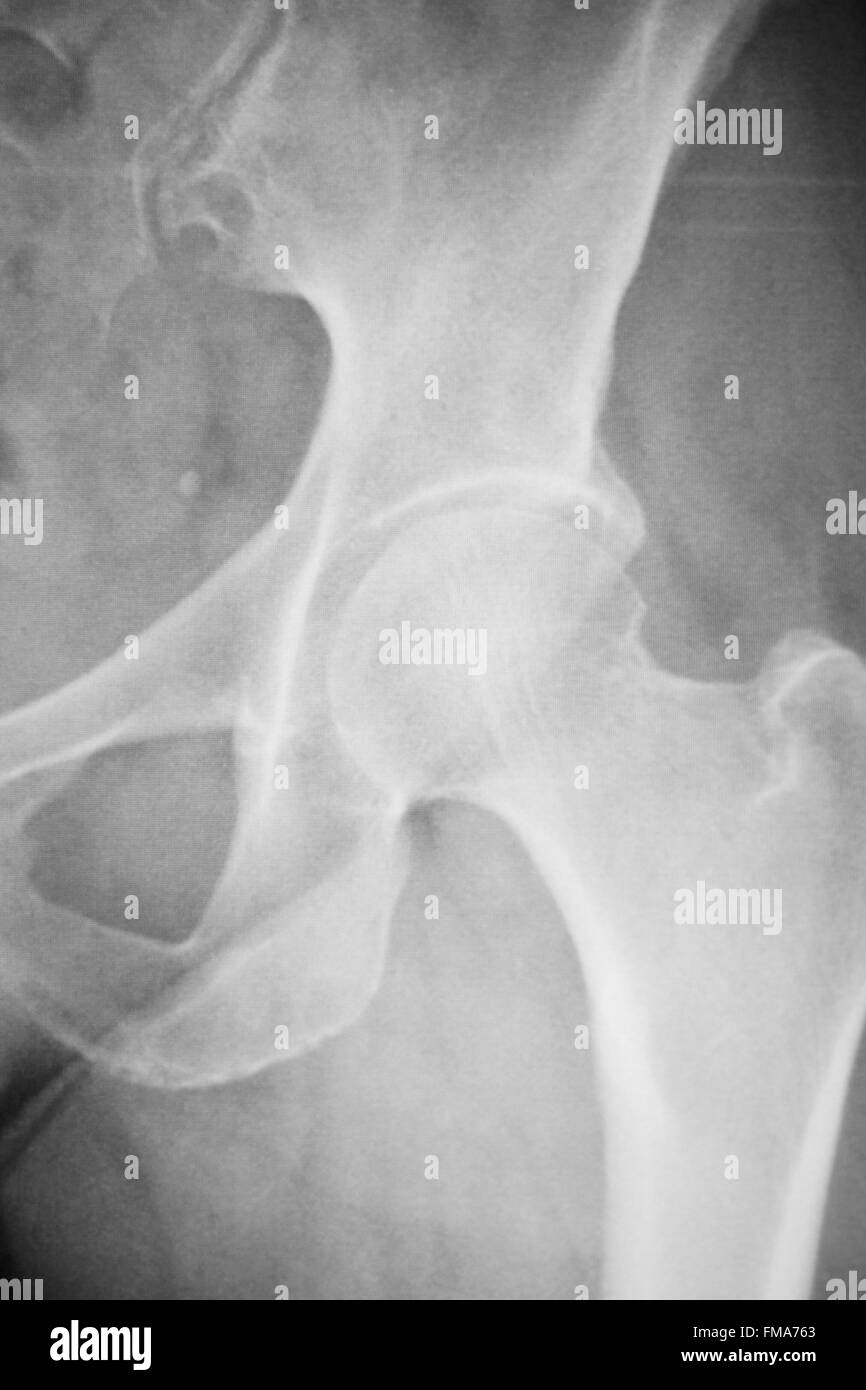 Hip, leg, thigh and pelvis injury medical x-ray test scan image of old ...
