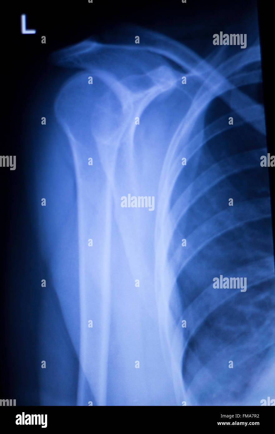 Spine vertebra ribs back injury vertebral column medical x-ray test ...