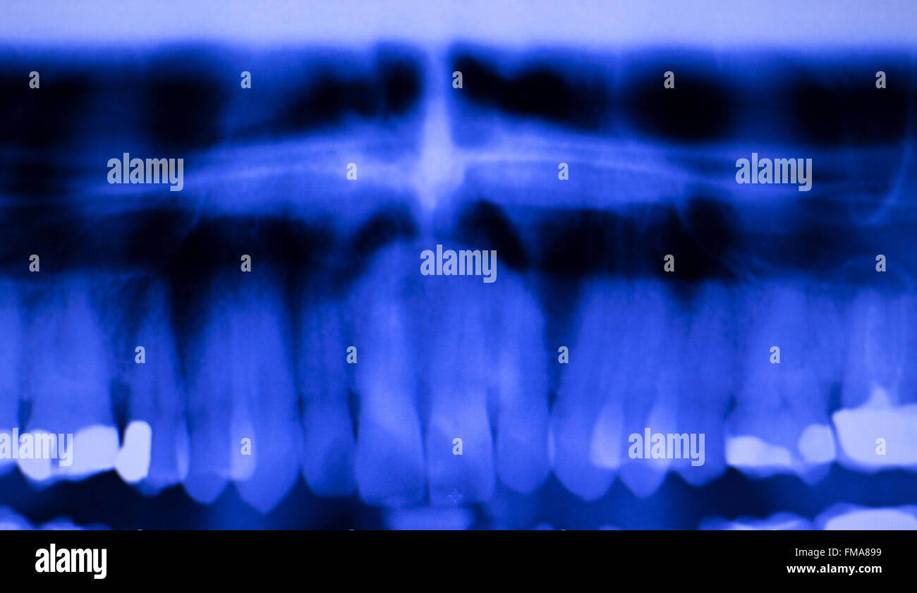 Dental teeth fillings, gum disease gingivitis dentists medical tooth x ...