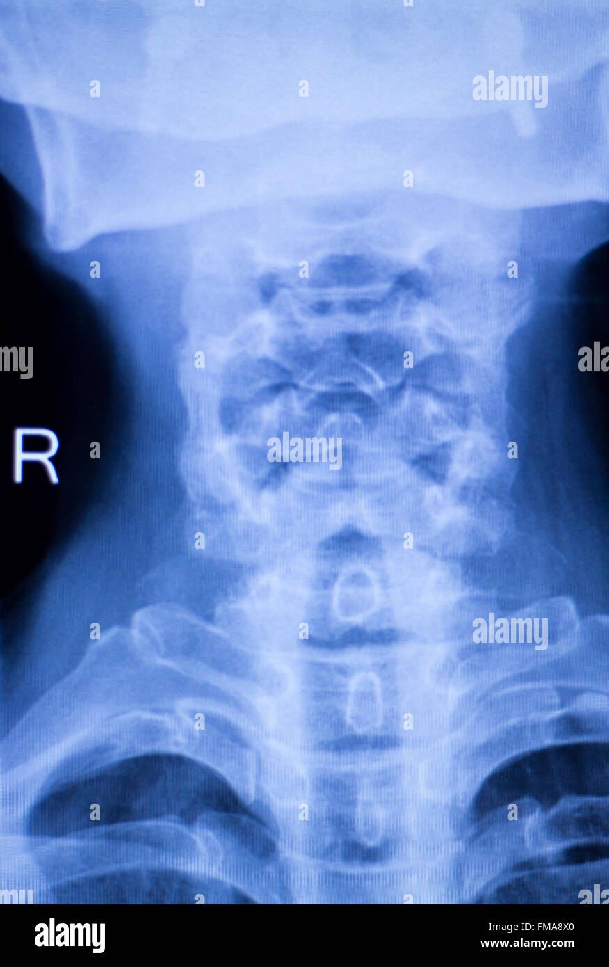 Skull, neck, spine, vertebra and shoulders injury medical x-ray test ...