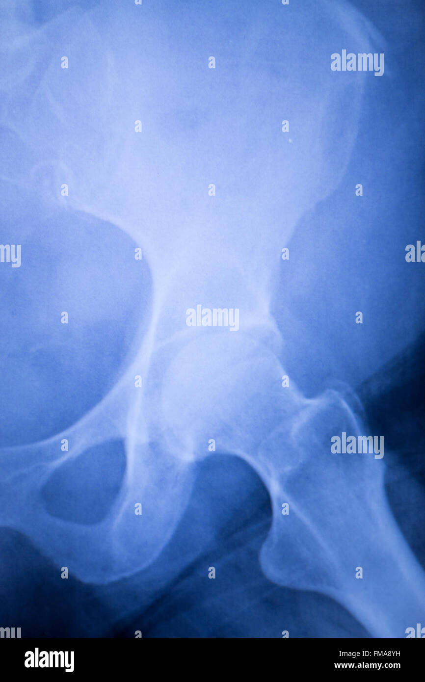 Hip, leg, thigh and pelvis injury medical x-ray test scan image of old ...