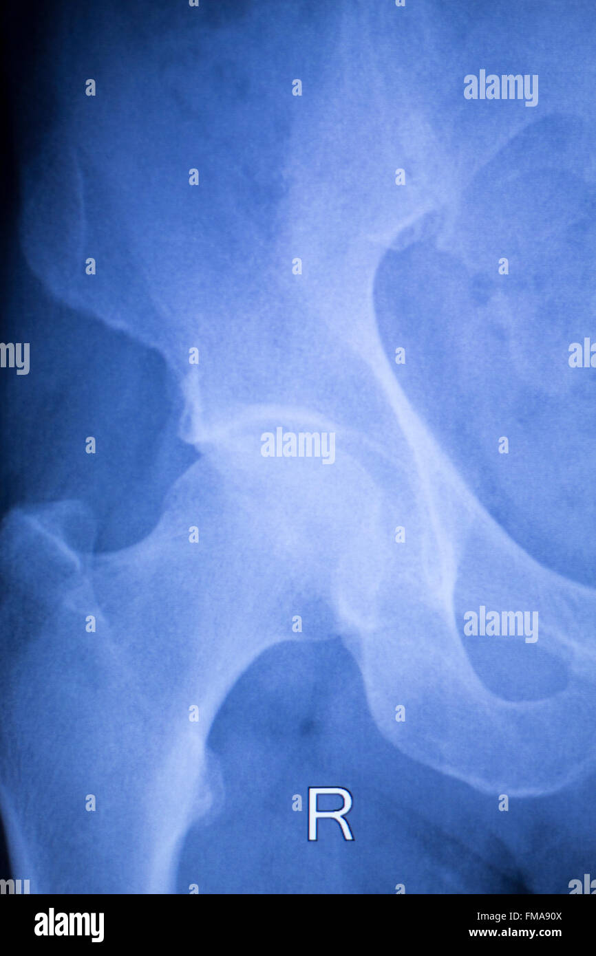 Hip, leg, thigh and pelvis injury medical x-ray test scan image of old ...