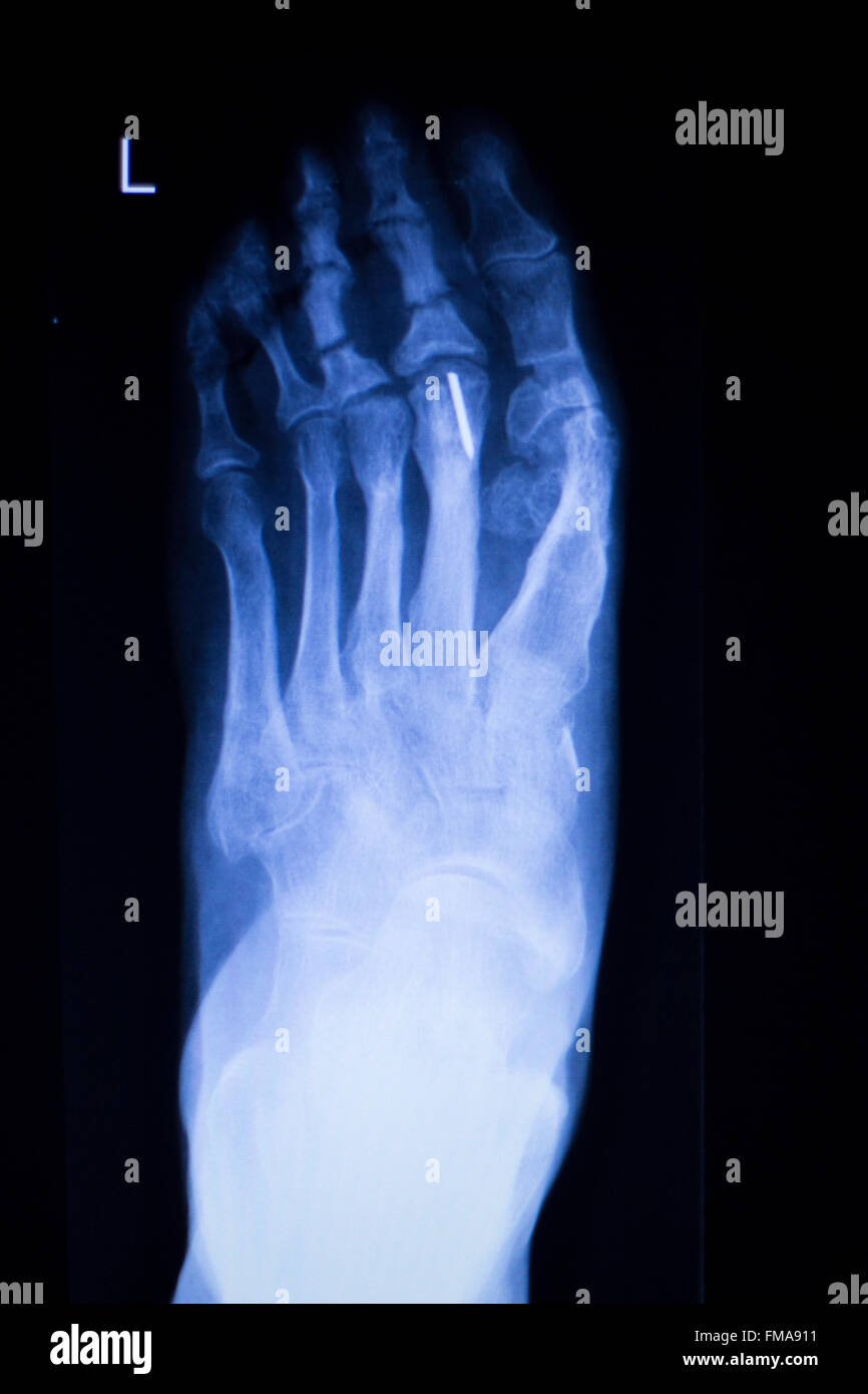 Foot and toes injury Traumatology medical x-ray Orthopedic test scan ...