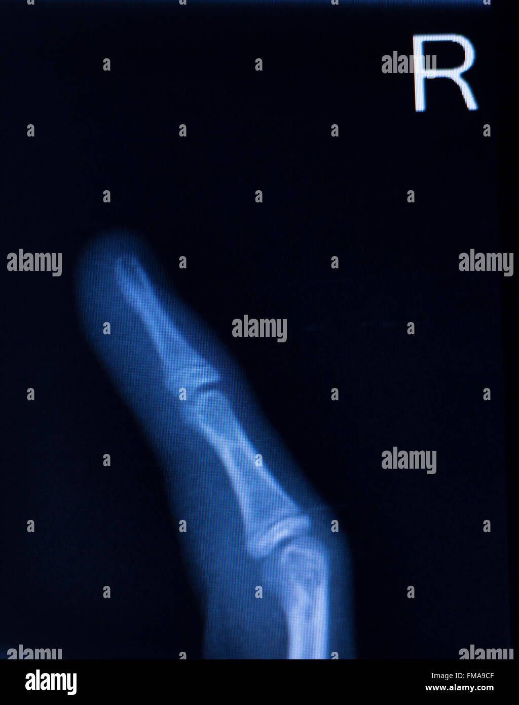 Hand and fingers injury orthopedic Traumatology medical x-ray test scan ...