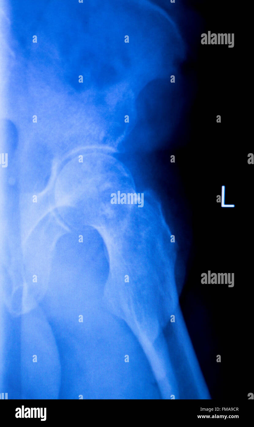 Hip, leg, thigh and pelvis injury medical x-ray test scan image of old ...