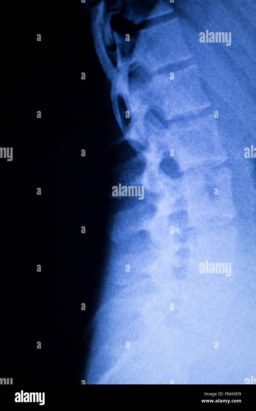 Spine vertebra back injury vertebral column medical x-ray test scan ...