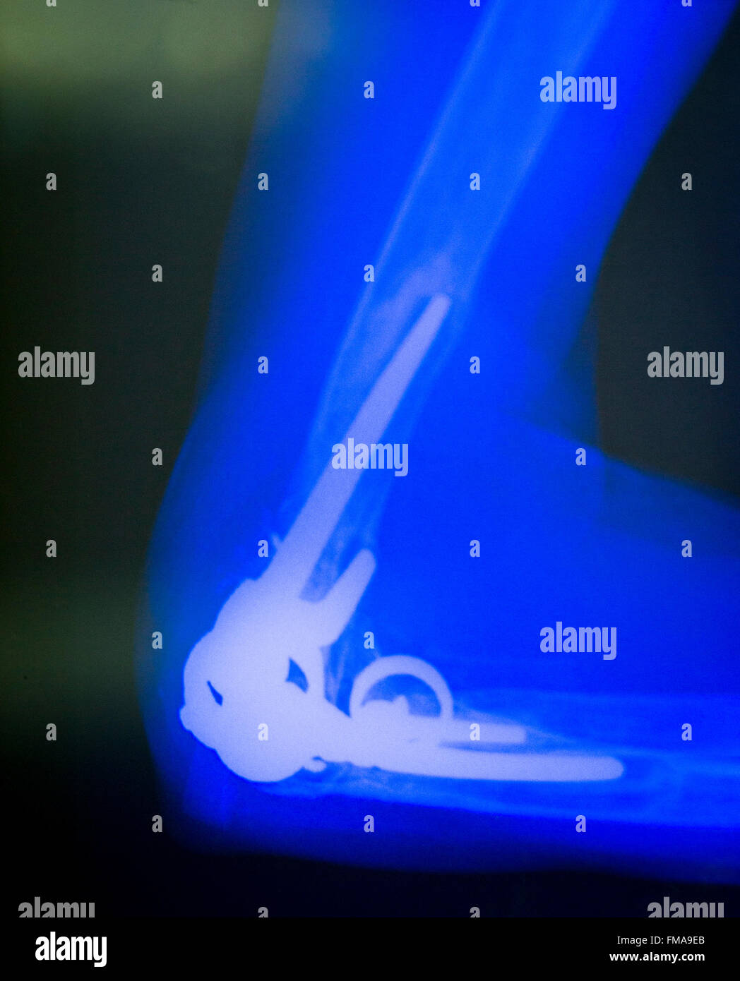 Elbow, arm and forearm orthopedic titanium metal replacement implant ...