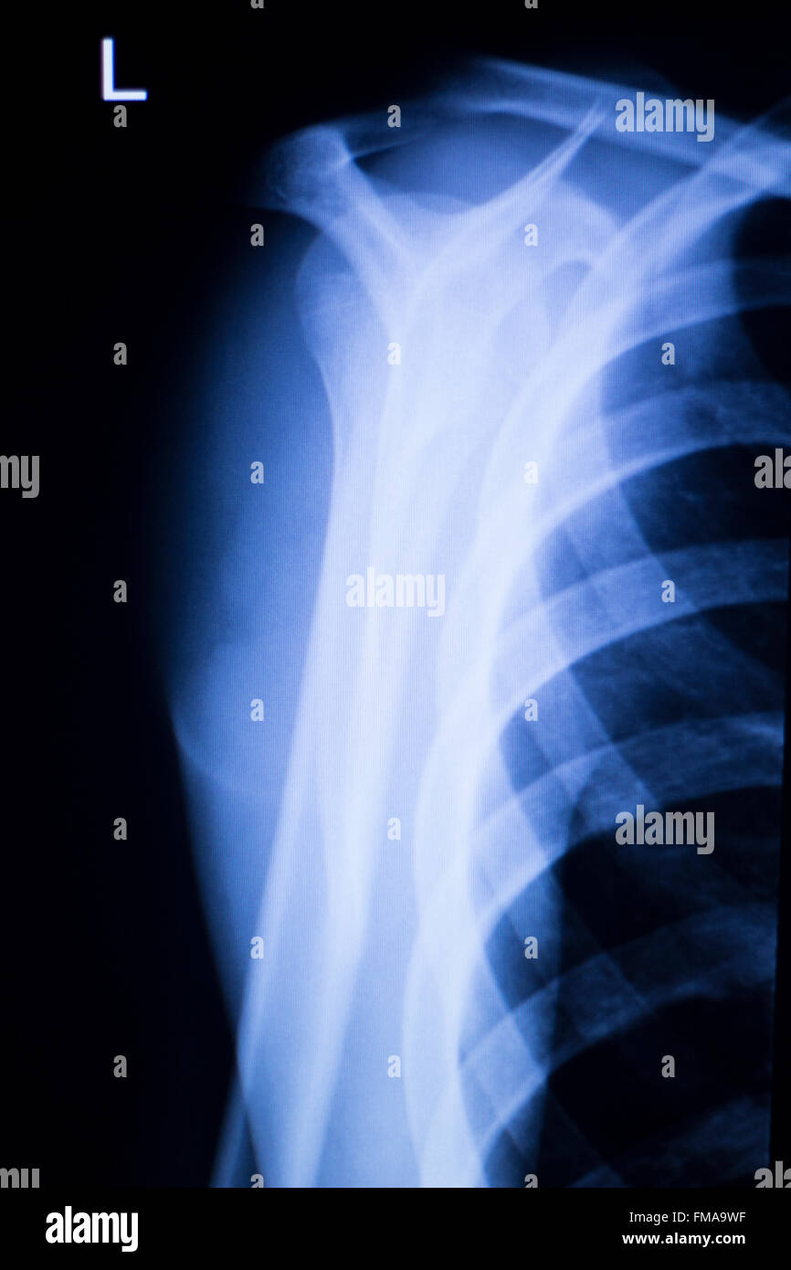 Spine vertebra ribs back injury vertebral column medical x-ray test ...