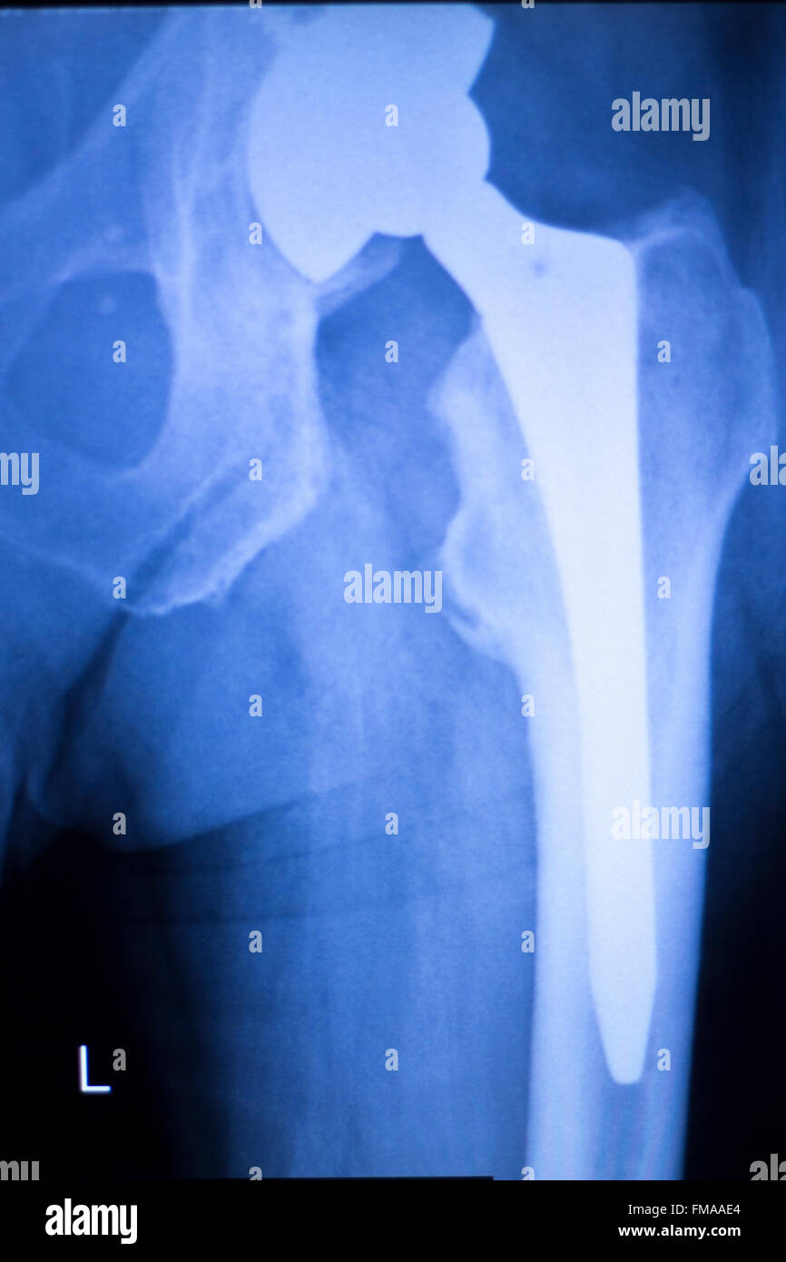 Hip joint meniscus orthopedic titanium metal replacement implant xray ...