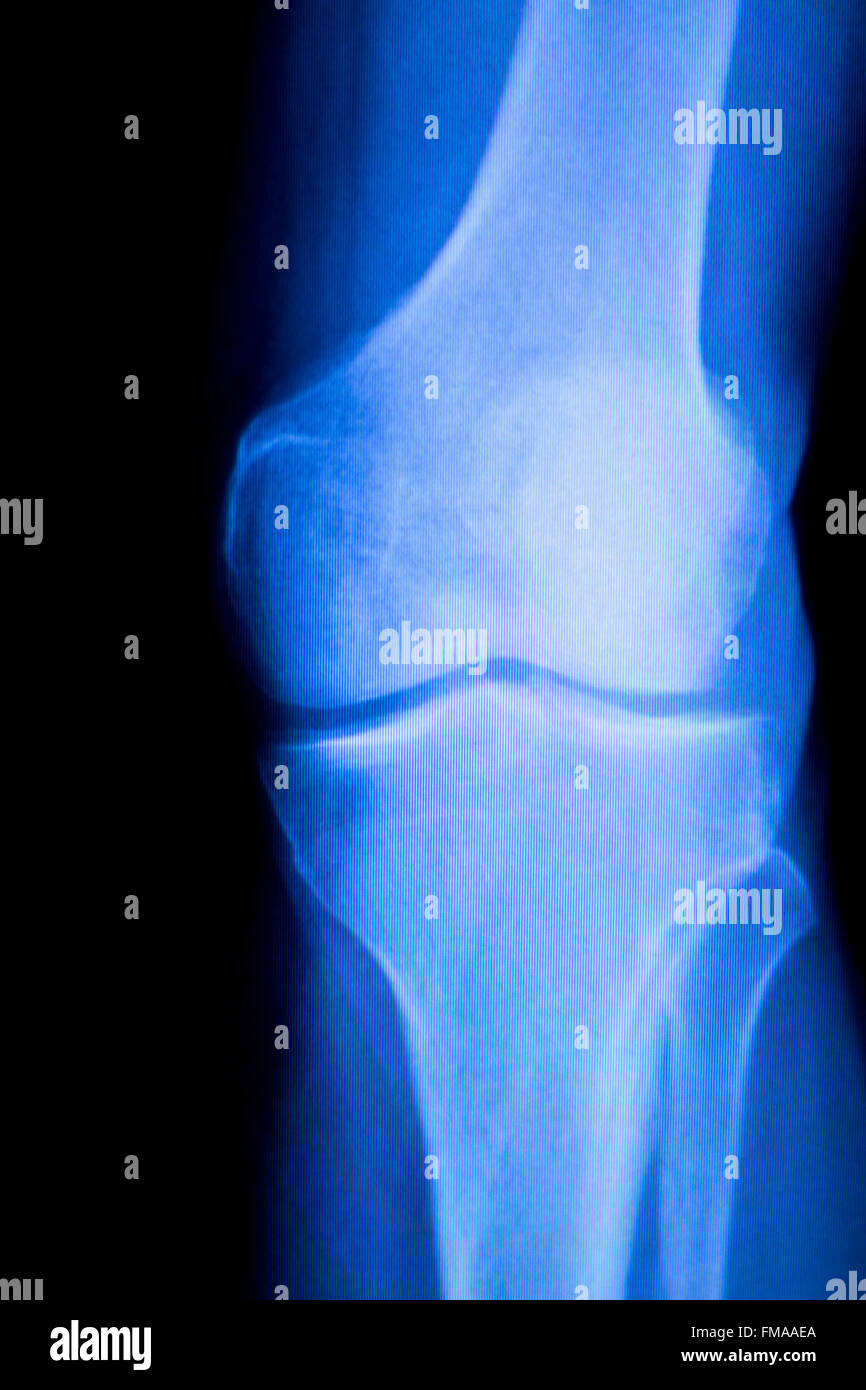 Knee and meniscus injury medical x-ray test scan result image Stock ...