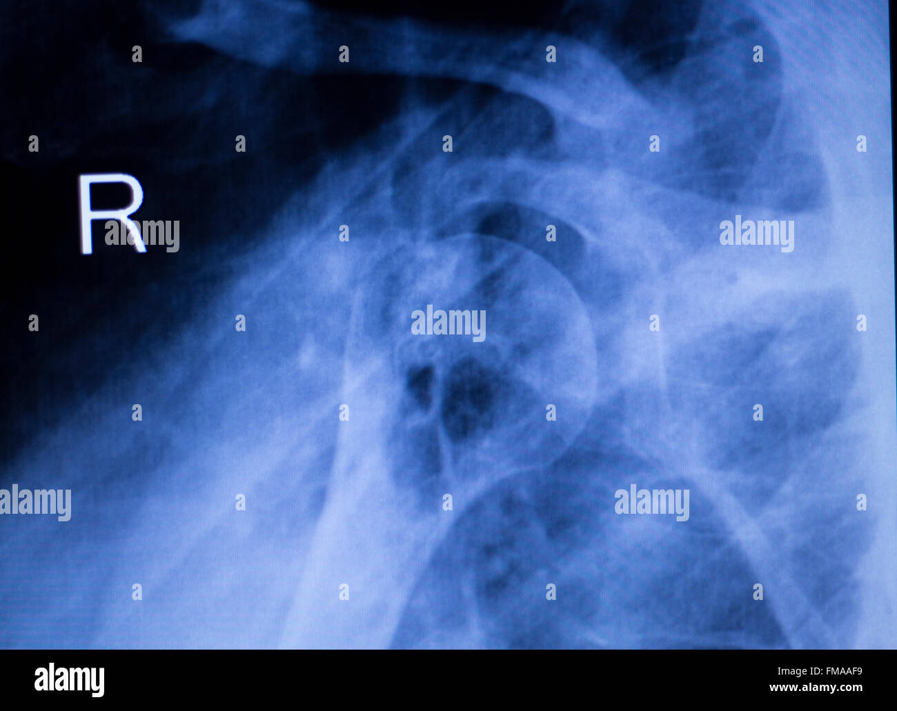 Spine vertebra ribs back injury vertebral column medical x-ray test ...