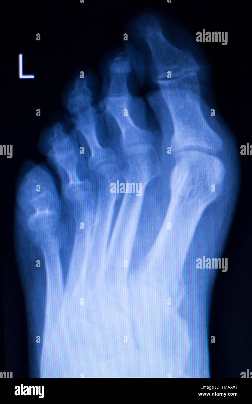 Foot and toes injury Traumatology medical x-ray Orthopedic test scan ...