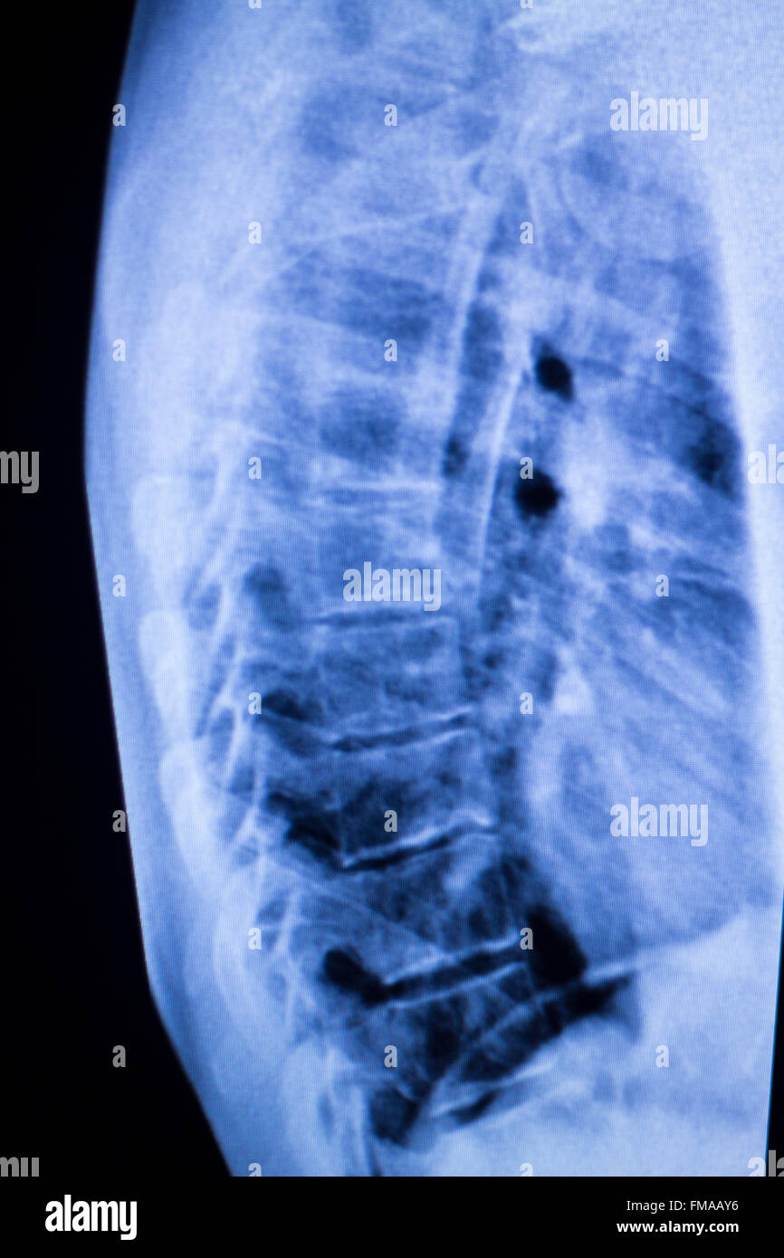 Spine vertebra back injury vertebral column medical x-ray test scan ...