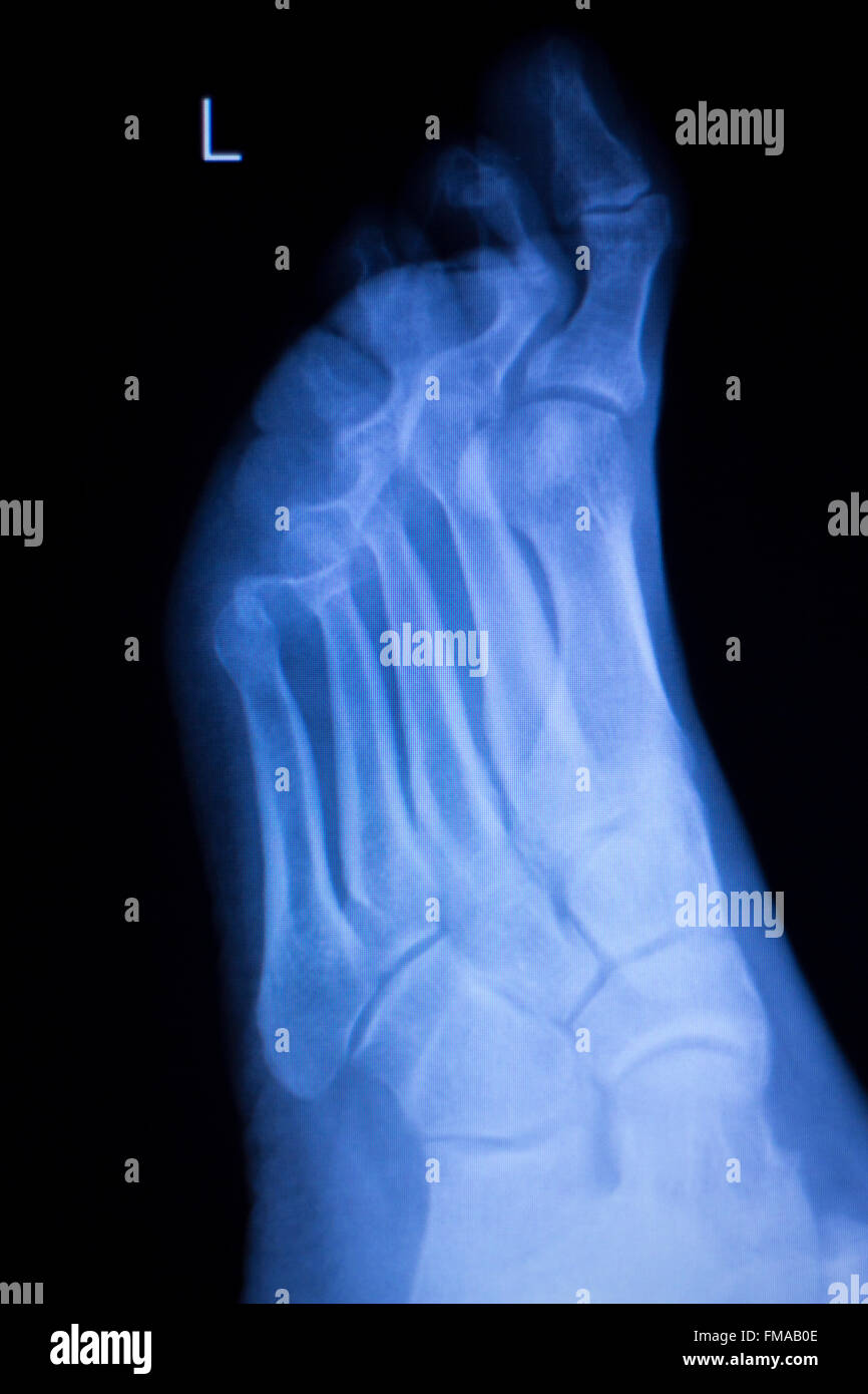 Foot and toes injury Traumatology medical x-ray Orthopedic test scan ...