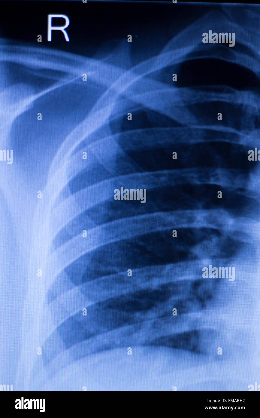 Spine vertebra ribs back injury vertebral column medical x-ray test ...