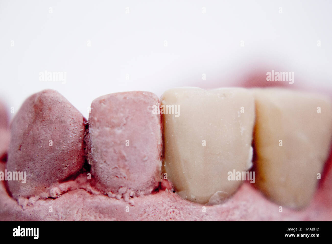 Dental prosthetics clay tooth mold in dentists laboratory photo Stock ...