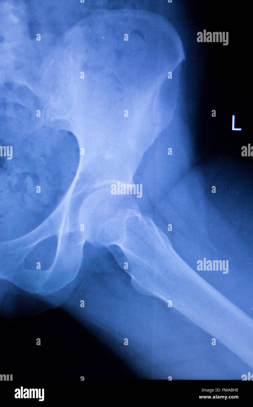 Hip, leg, thigh and pelvis injury medical x-ray test scan image of old ...