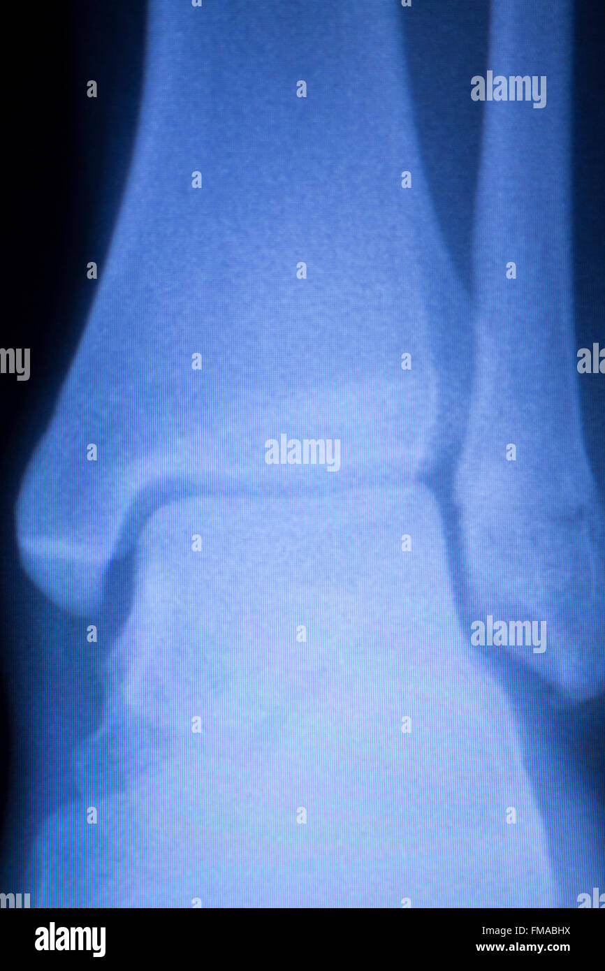 Shin, lower leg and ankle injury Traumatology medical x-ray Orthopedic ...
