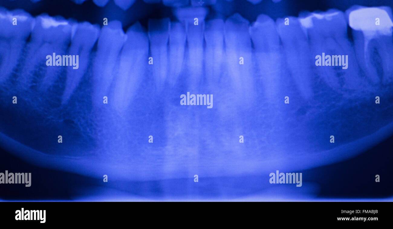 Dental teeth fillings, gum disease gingivitis dentists medical tooth x ...