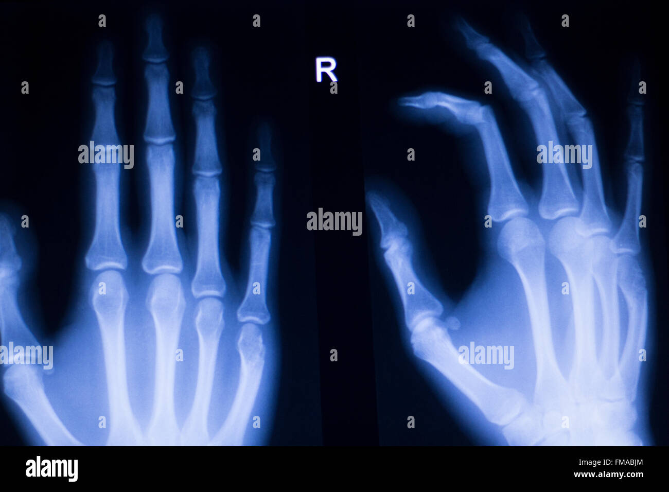 Hand, fingers, thumb and wrist injury orthopedic Traumatology medical x ...