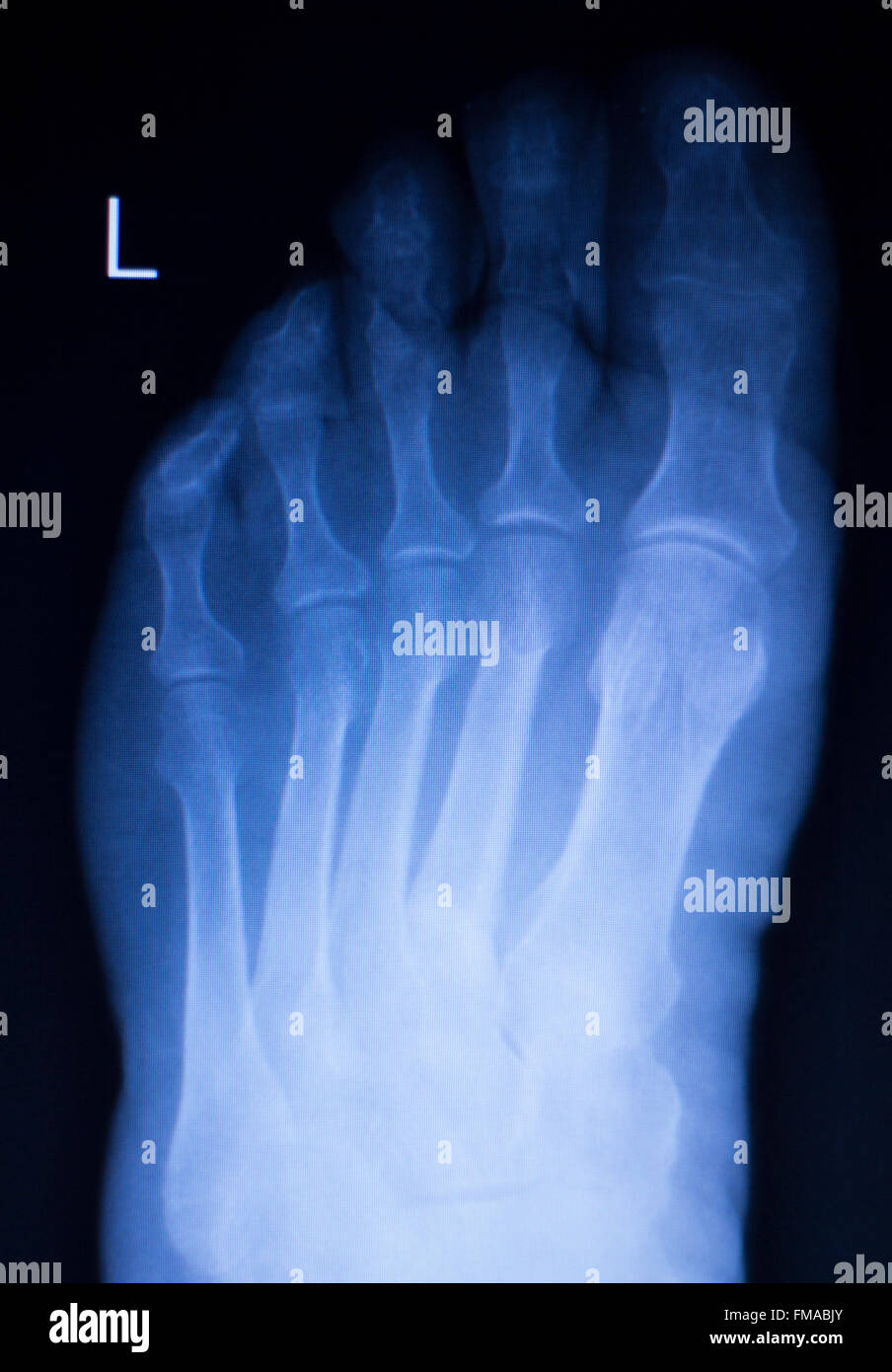 Foot and toes injury Traumatology medical x-ray Orthopedic test scan ...