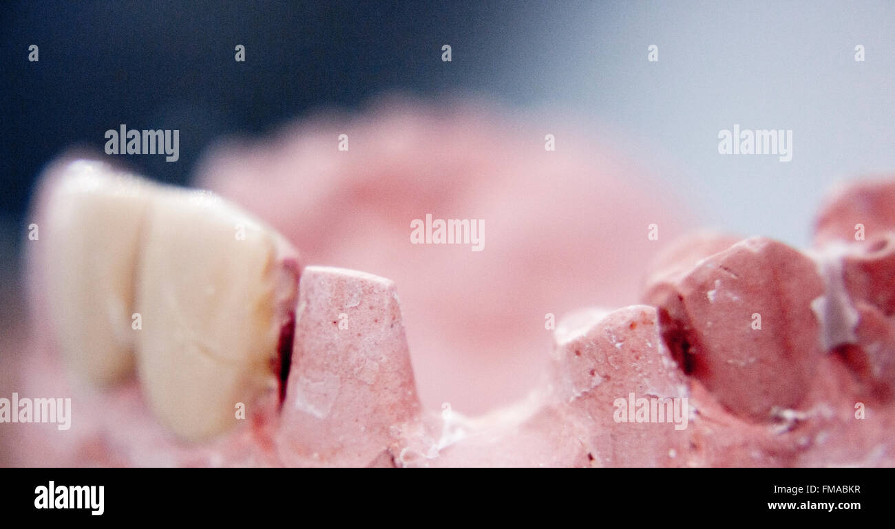 Dental prosthetics clay tooth mold in dentists laboratory photo Stock ...