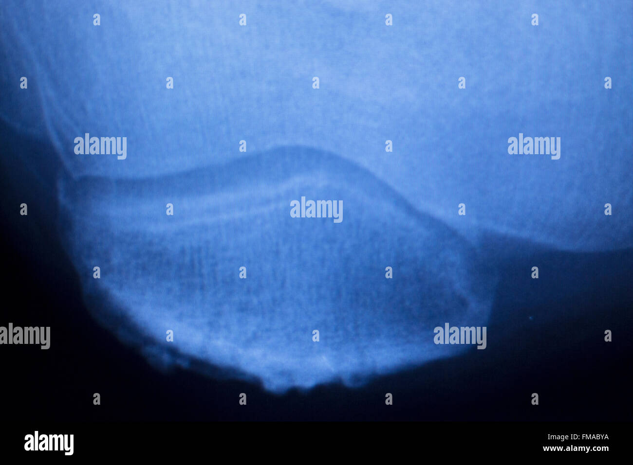 Knee and meniscus injury medical x-ray test scan result image Stock ...