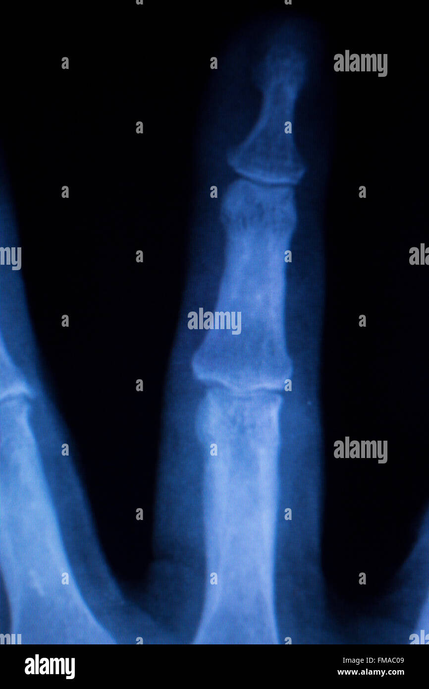 Hand and fingers injury orthopedic Traumatology medical x-ray test scan ...
