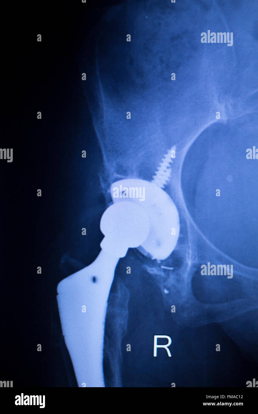 Hip joint meniscus orthopedic titanium metal replacement implant xray ...