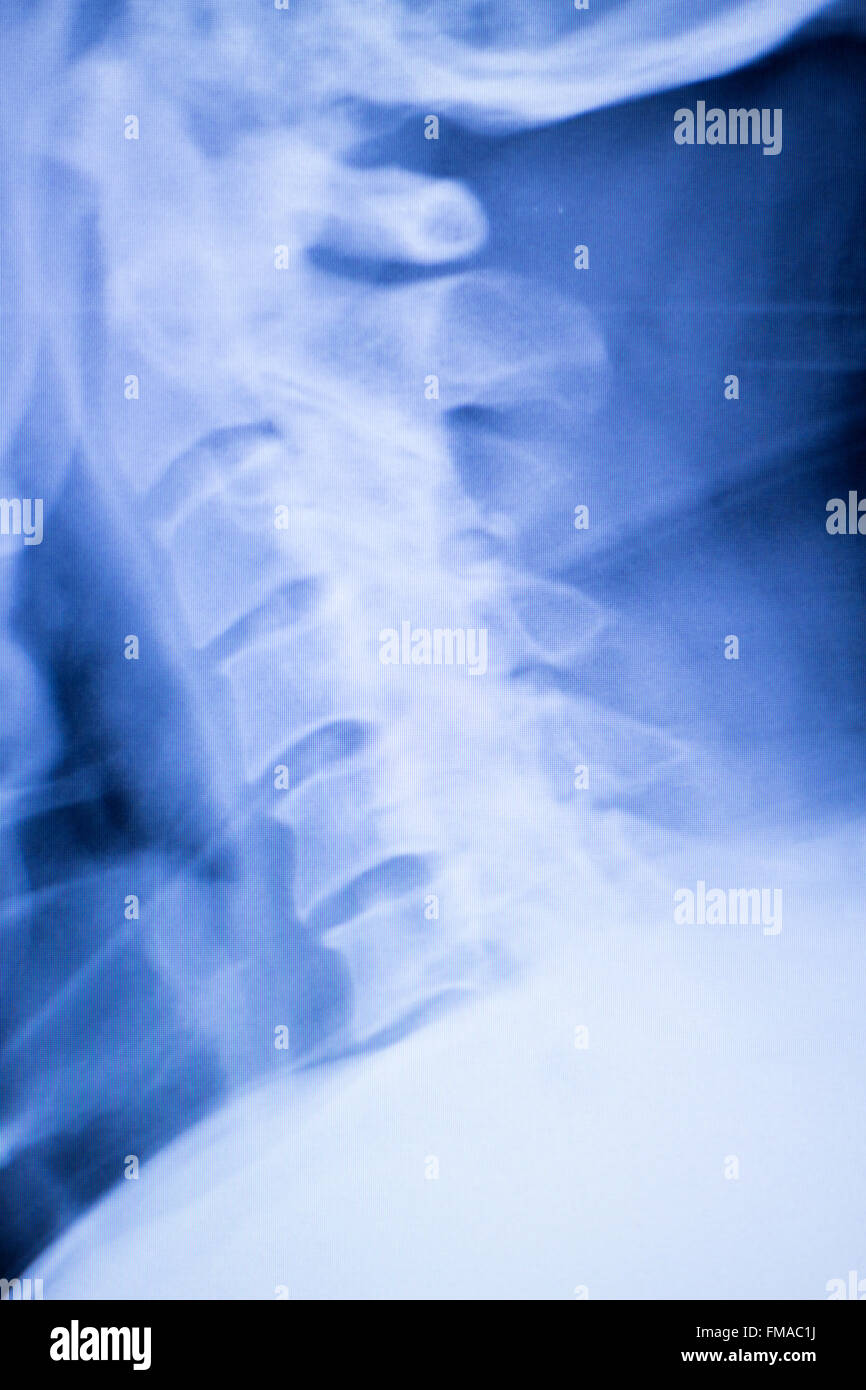 Skull, neck, spine, vertebra and shoulders injury medical x-ray test ...