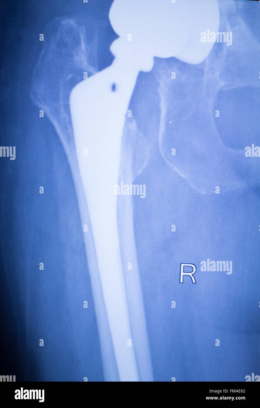 Hip Replacement Xray High Resolution Stock Photography and Images - Alamy