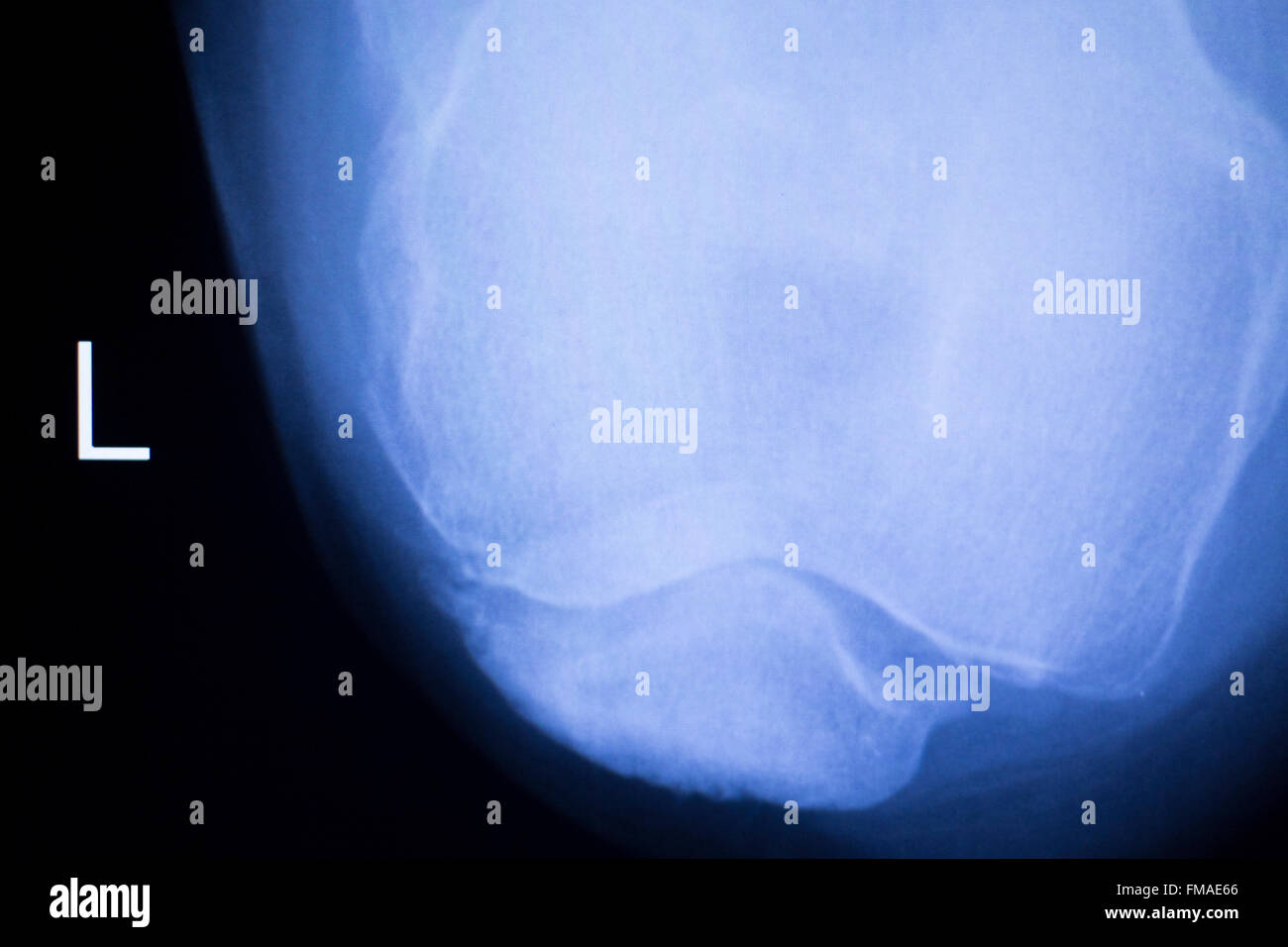 Knee and meniscus injury medical x-ray test scan result image Stock ...