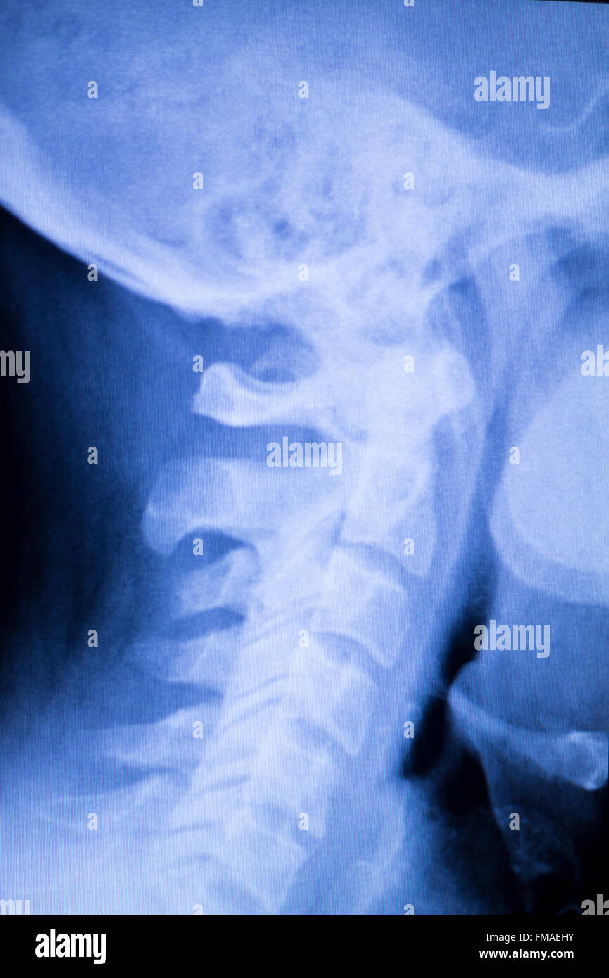 Skull, neck, spine, vertebra and shoulders injury medical x-ray test ...