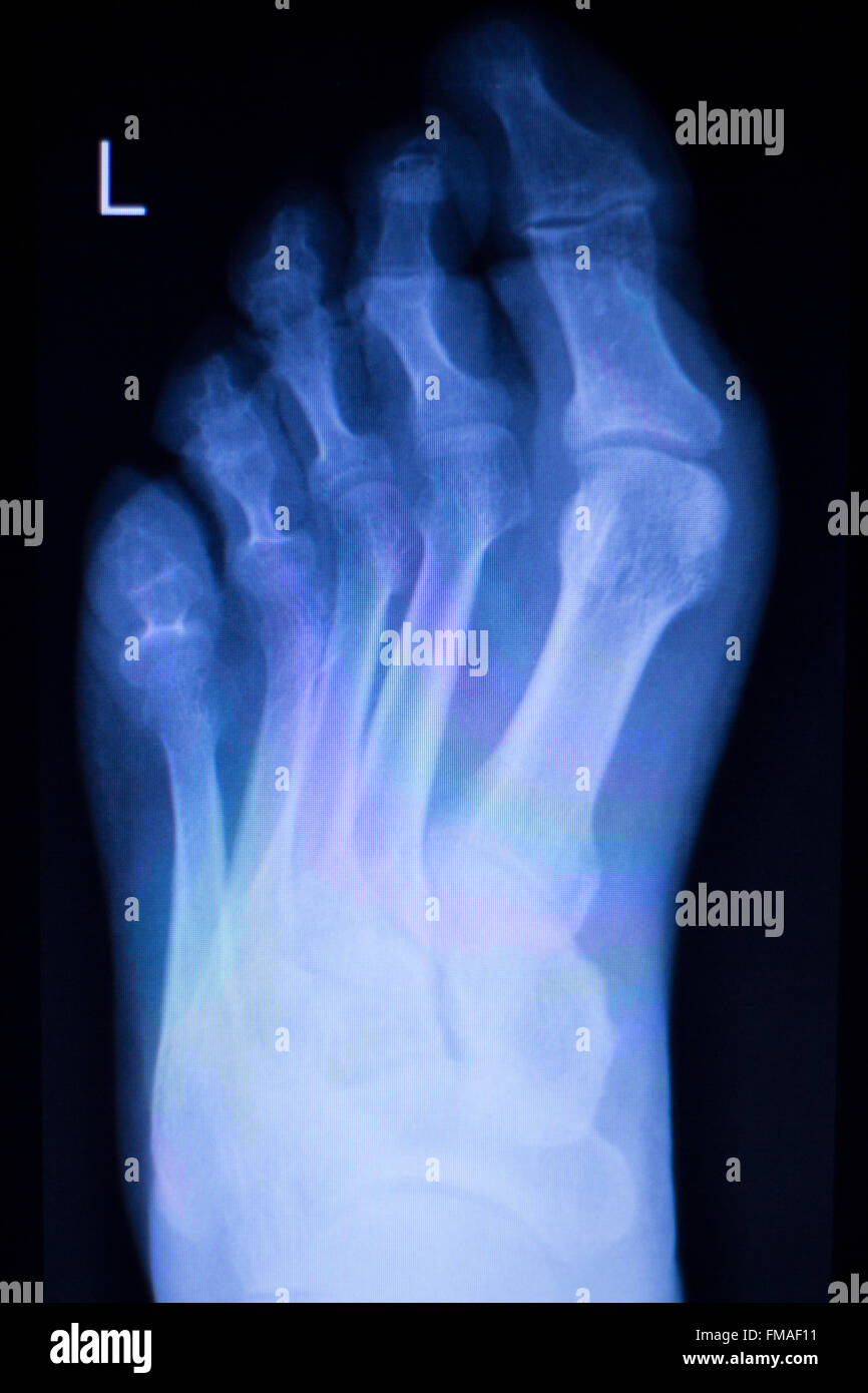 Foot and toes injury Traumatology medical x-ray Orthopedic test scan ...