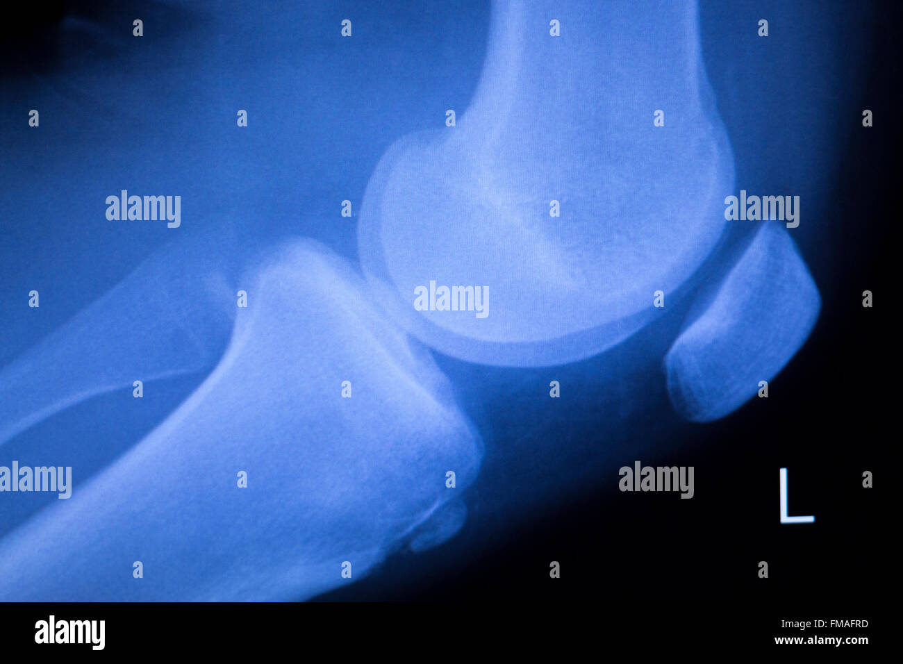 Knee and meniscus injury medical x-ray test scan result image Stock ...