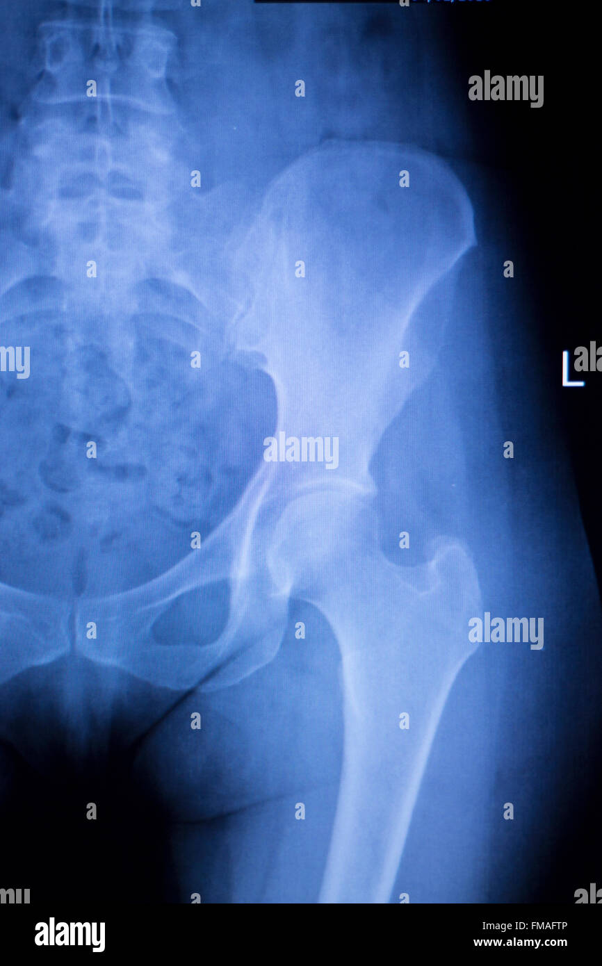Hip, leg, thigh and pelvis injury medical x-ray test scan image of old ...