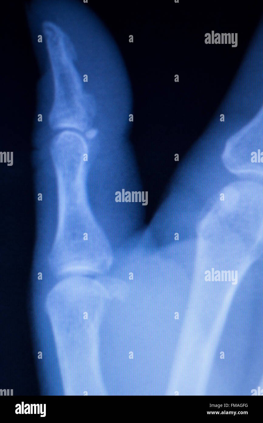 Hand and fingers injury orthopedic Traumatology medical x-ray test scan ...