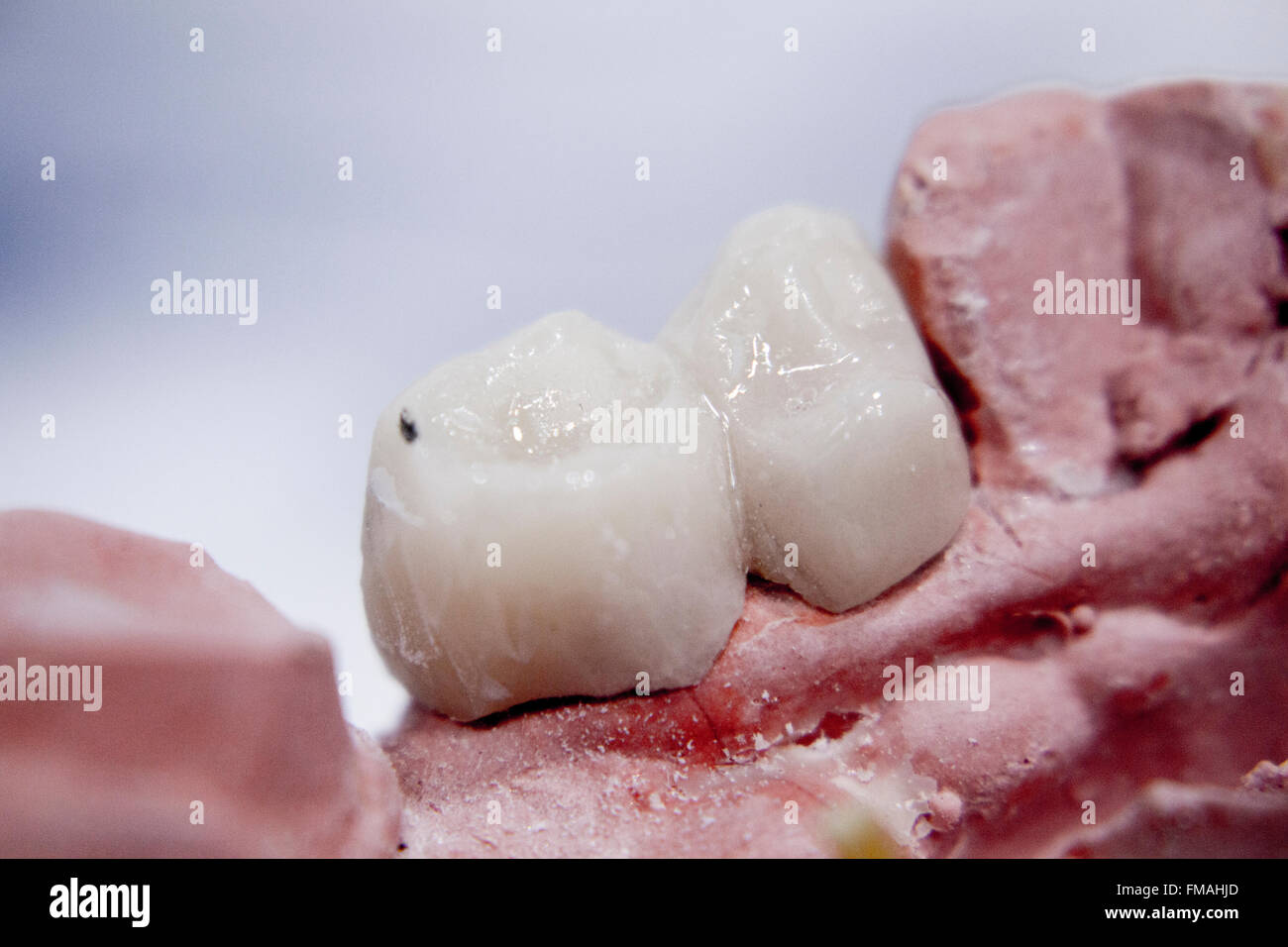 Dental prosthetics clay tooth mold in dentists laboratory photo Stock ...