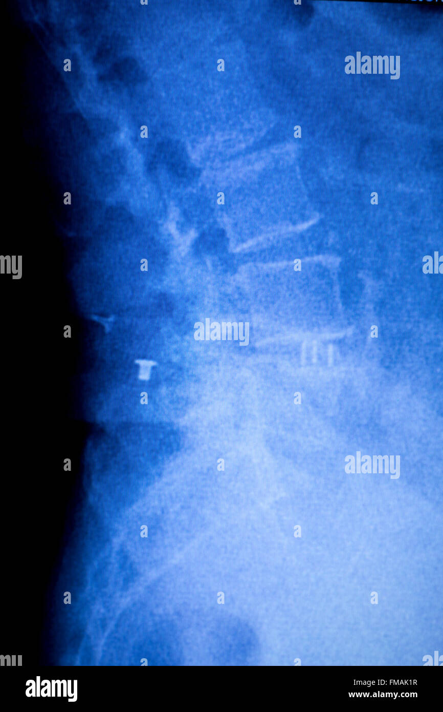 Spine vertebra back injury vertebral column medical x-ray test scan ...