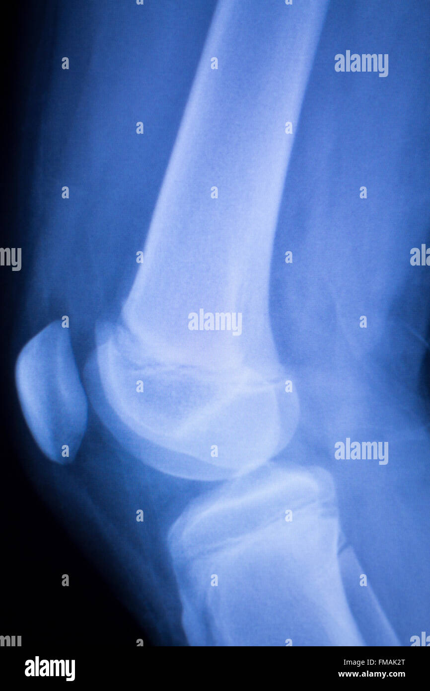 Knee and meniscus injury medical x-ray test scan result image Stock ...