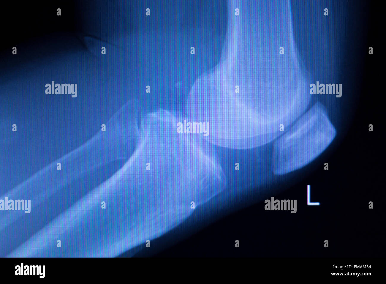 Knee and meniscus injury medical x-ray test scan result image Stock ...
