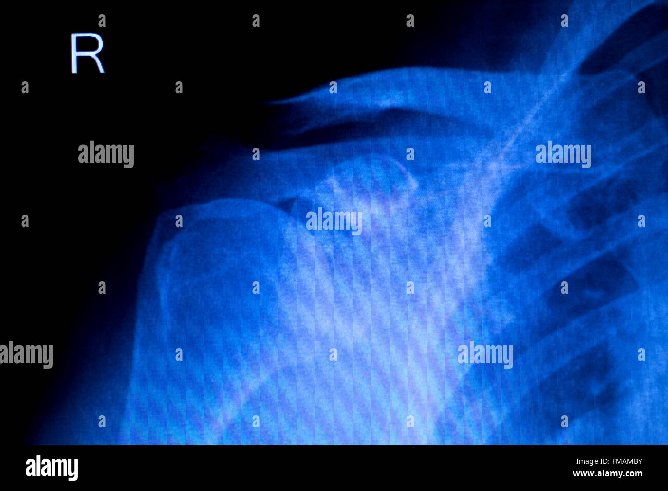Spine vertebra ribs back injury vertebral column medical x-ray test ...